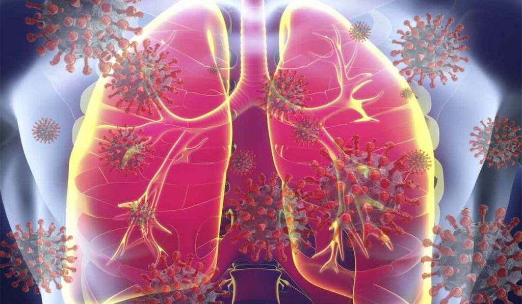 Pneumonia virala sau bacteriana. Care sunt primele simptome si ce ...
